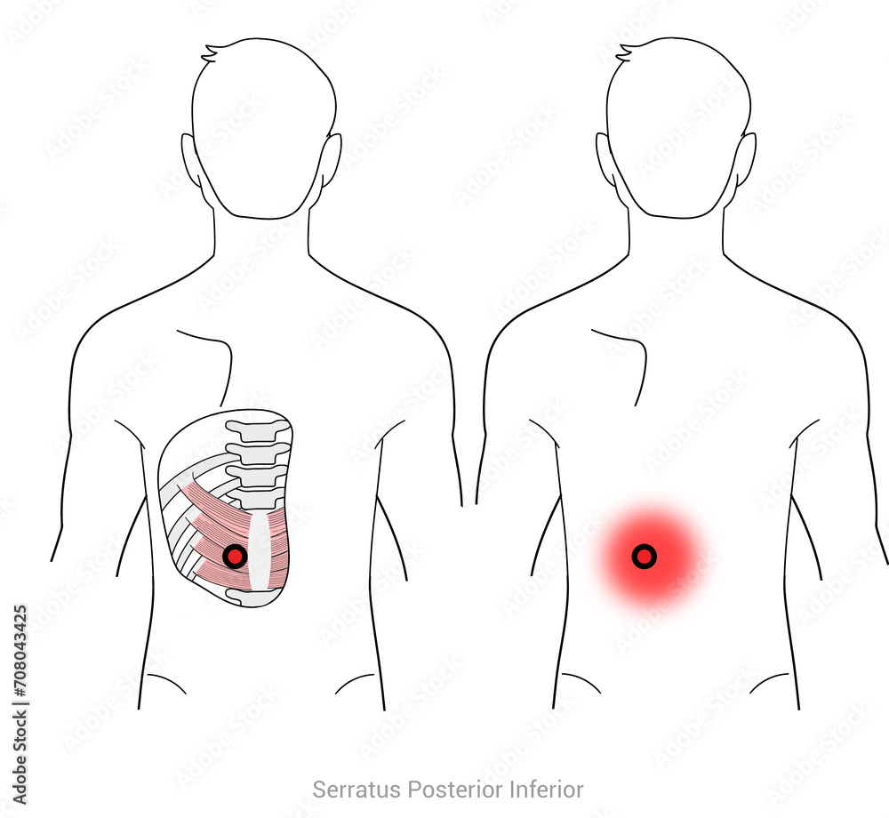 Serratus Posterior Inferior: Myofascial trigger points and associated ...