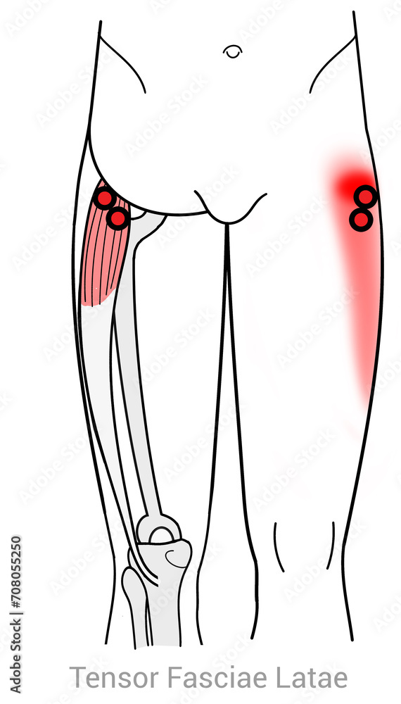 Tensor Fasciae Latae: Myofascial trigger points and associated pain ...