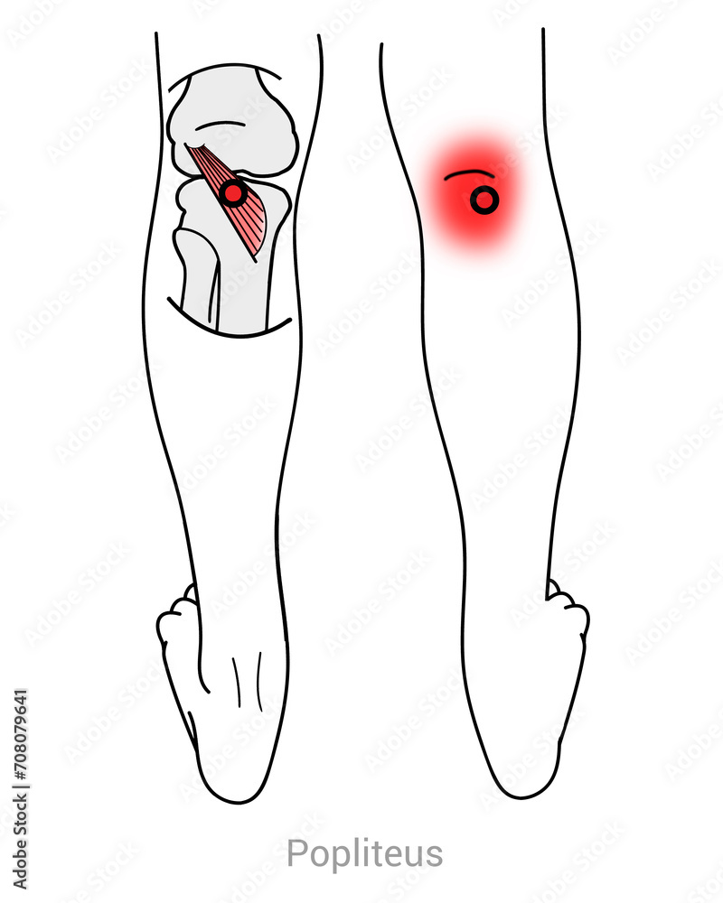 Popliteus: Myofascial trigger point and associated pain locations Stock ...