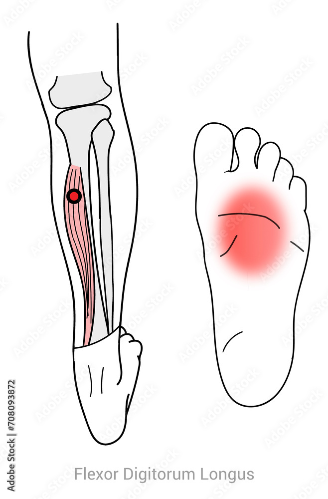 Flexor Digitorum Longus: Myofascial trigger points and associated pain ...