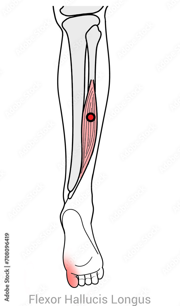 Flexor Hallucis Longus: Myofascial trigger points and associated pain ...