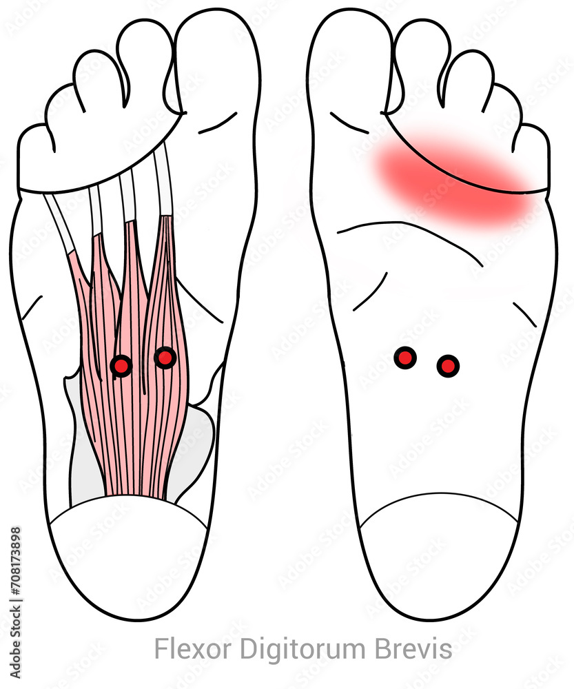 Flexor Digitorum Brevis: Myofascial trigger points and associated pain ...