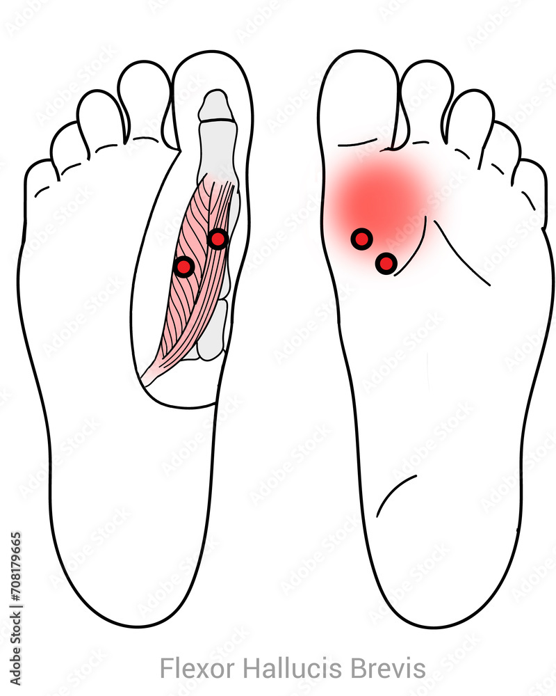 Flexor Hallucis Brevis: Myofascial trigger points and associated pain ...