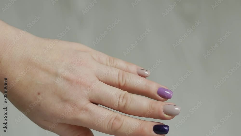 Vidéo Stock A woman's hand with a swollen finger from inflammation due ...