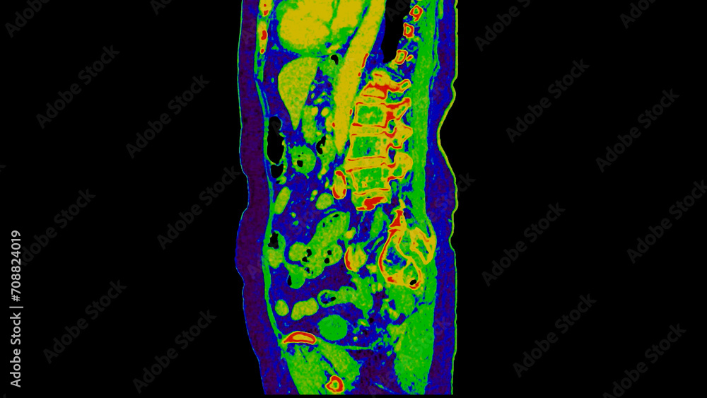 CT scan of Abdomen sagittal view with injection contrast media with ...