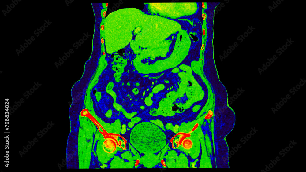 CT scan of Abdomen coronal view with injection contrast media with ...
