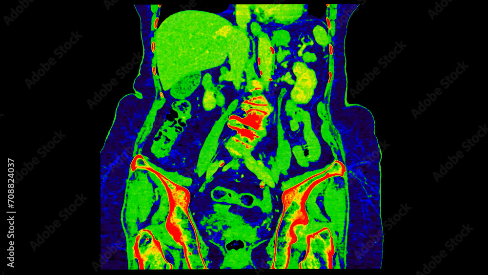 CT scan of Abdomen coronal view with injection contrast media with ...