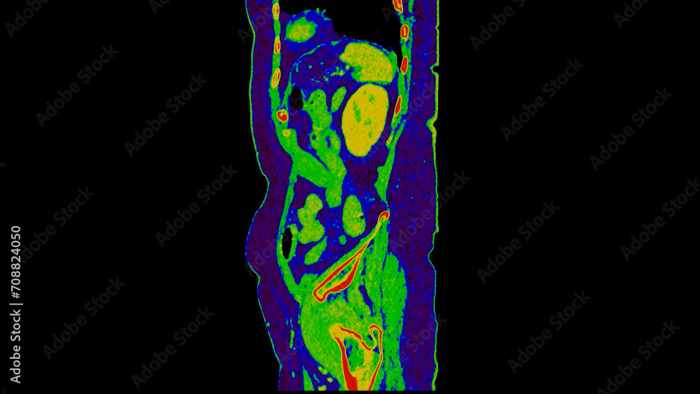 CT scan of Abdomen sagittal view with injection contrast media with ...