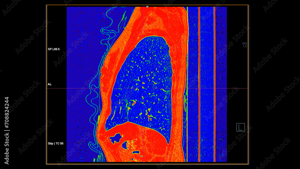 CT scan of Chest sagittal view in color mode for diagnostic Pulmonary ...