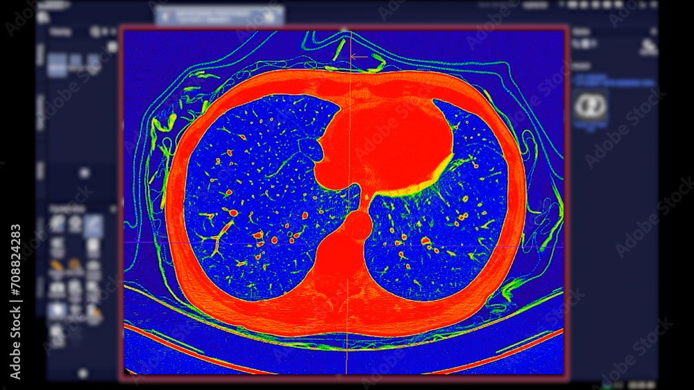 CT scan of Chest Axial view in color mode for diagnostic Pulmonary ...