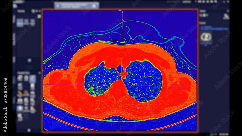CT scan of Chest Axial view in color mode for diagnostic Pulmonary ...