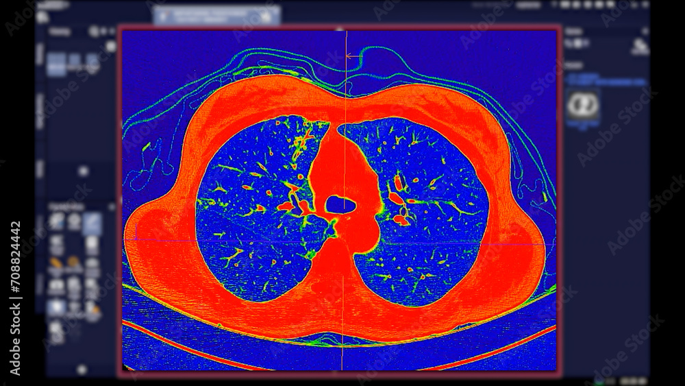 CT scan of Chest Axial view in color mode for diagnostic Pulmonary ...