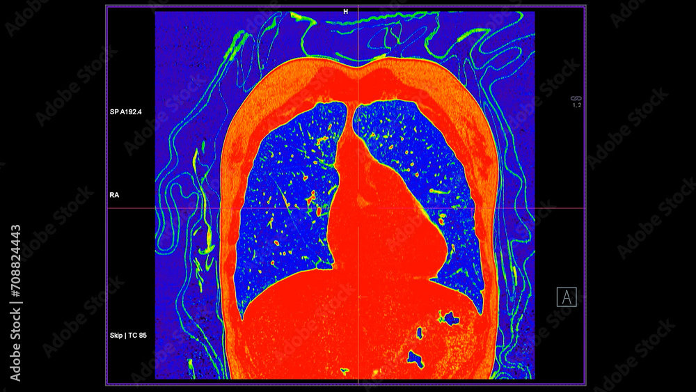 CT scan of Chest coronal view in color mode for diagnostic Pulmonary embolism (PE) , lung cancer ...
