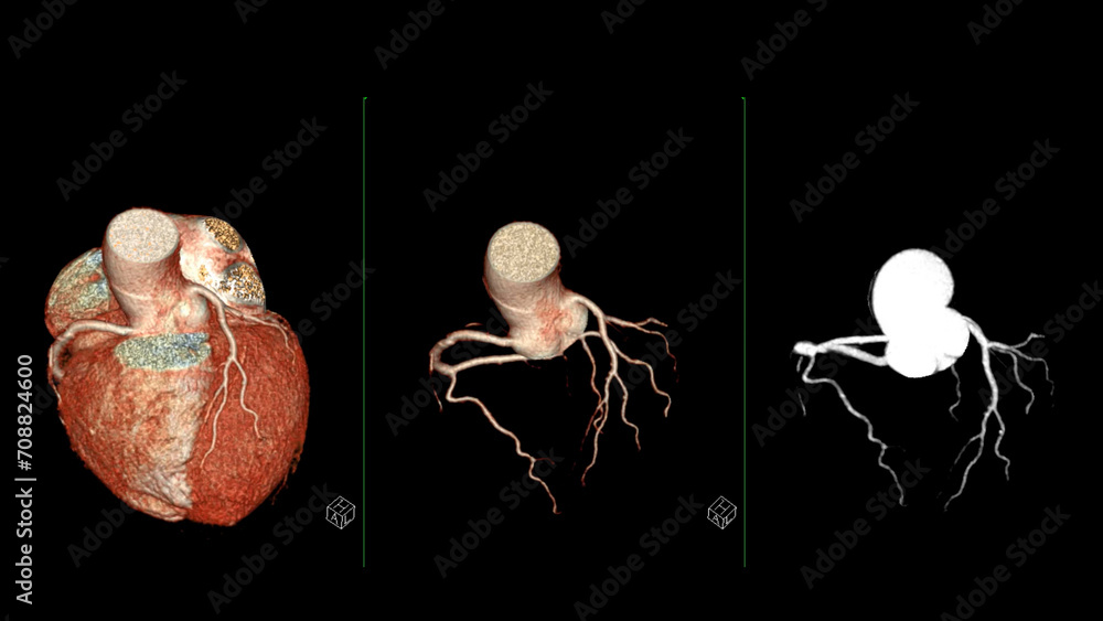 CTA coronary artery 3D rendering is a diagnostic imaging technique ...