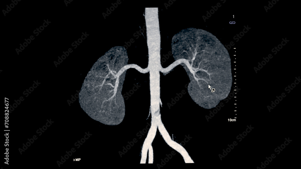 CTA Renal artery 3D is a medical imaging procedure using CT scans to ...