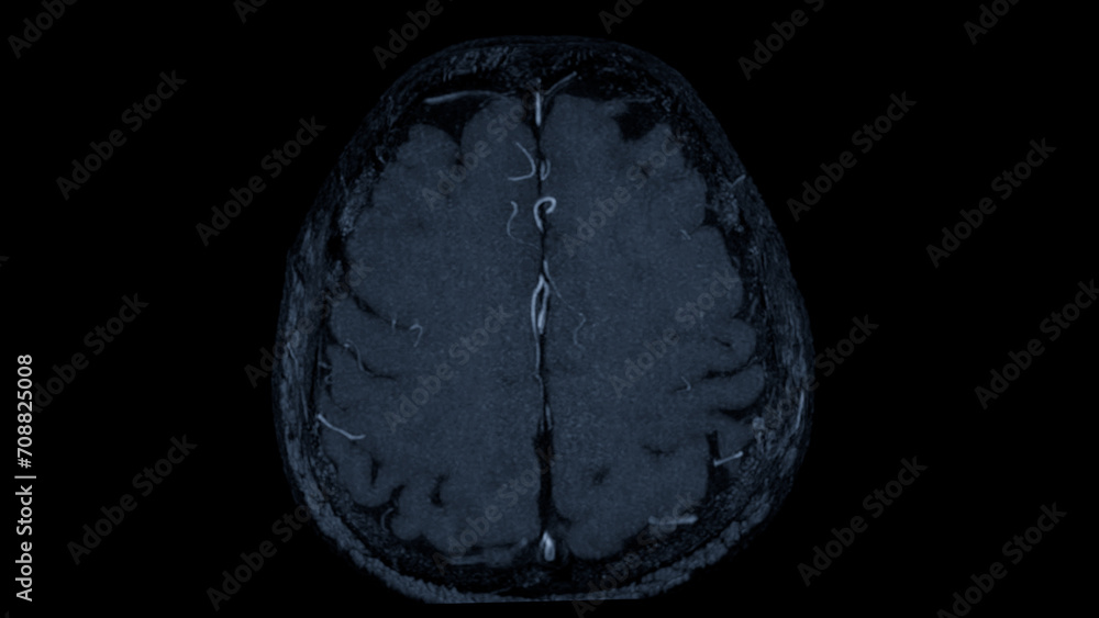 MRA Brain axial view , This imaging technique provides clear visuals of ...