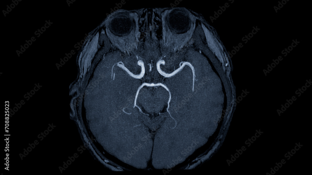 MRA Brain axial view , This imaging technique provides clear visuals of ...