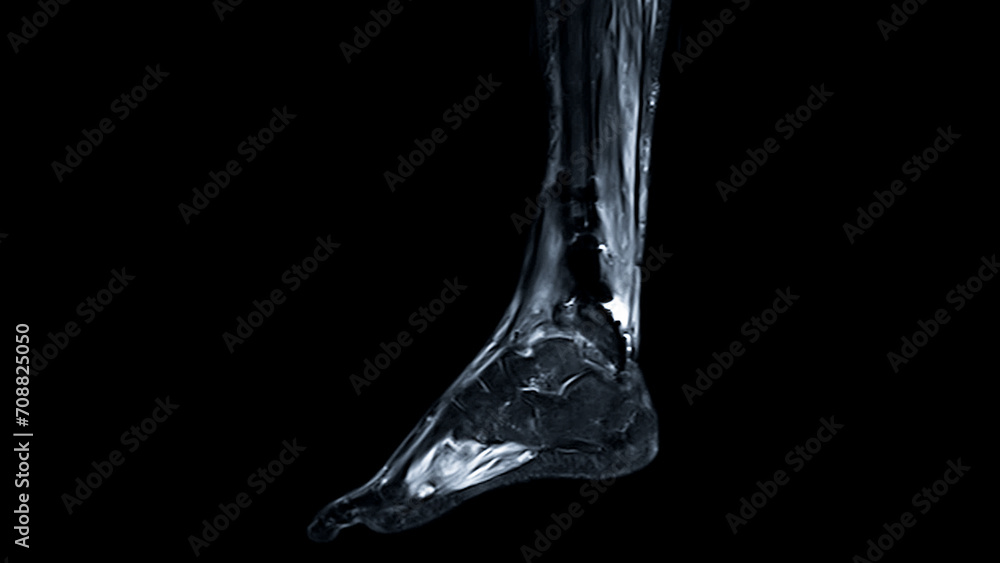 MRI FOOT scan Sagittal view T2 Fat suppression technique for diagnostic ...