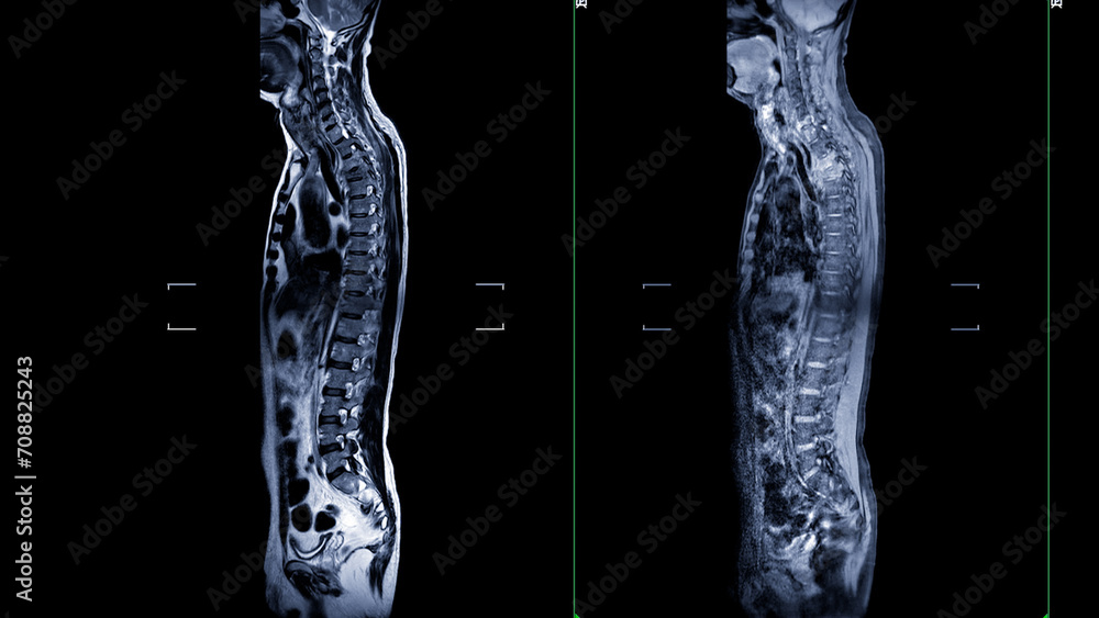 An MRI of the whole spine image is a comprehensive visual ...