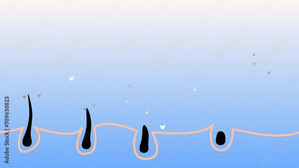 Vidéo Stock Dandruff hair care. Action of anti-dandruff shampoo on hair ...