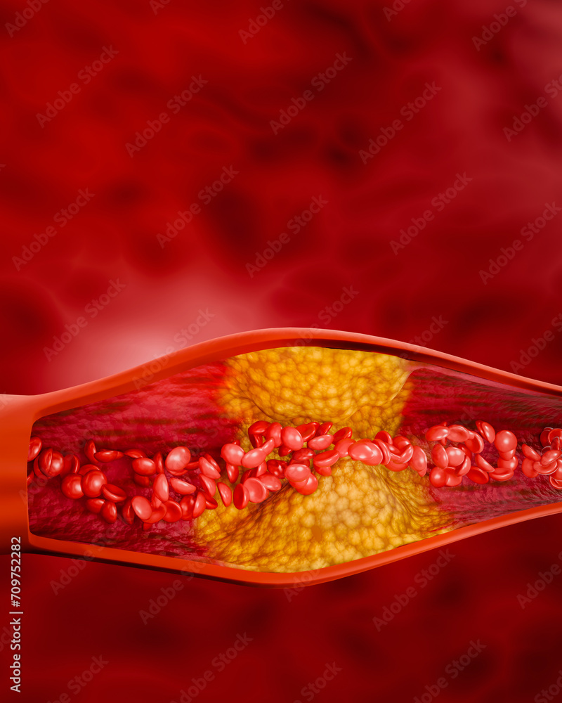 Expansion fat in the blood vessels. Hyperlipidemia or arteriosclerosis ...