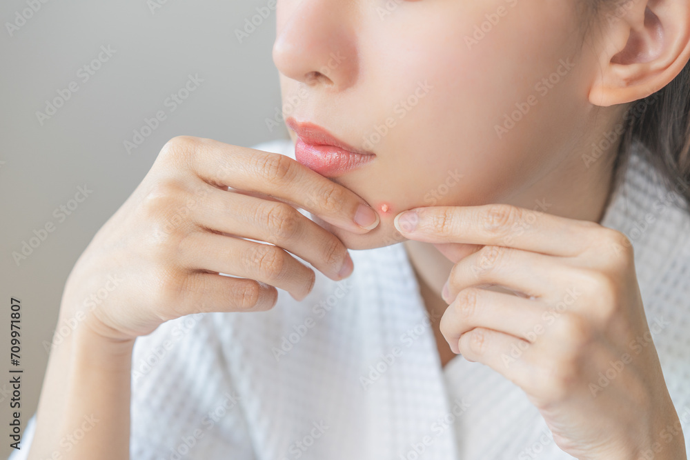 Expression worry asian young woman hand touching pustule around the ...