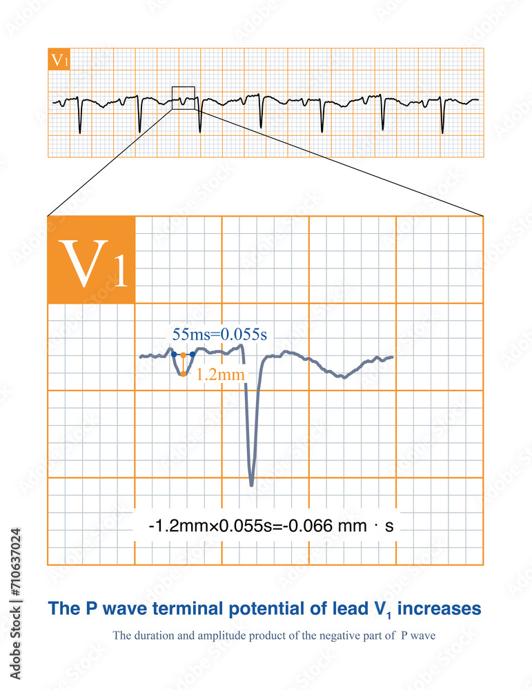 When the left atrium is abnormal, the absolute value of the duration ...