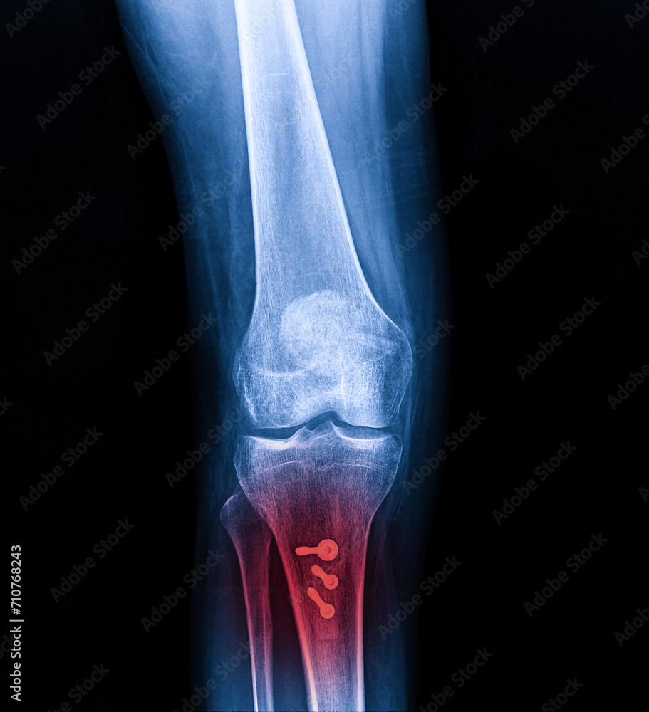 X Ray Knee Joint Fracture Proximal Tibia And Post Fix Fracture Proximal