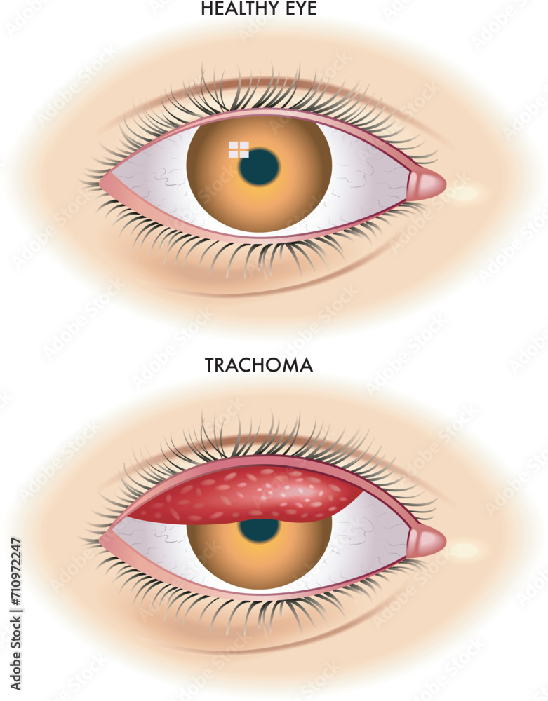 Medical illustration shows the comparison between a normal eye and one ...