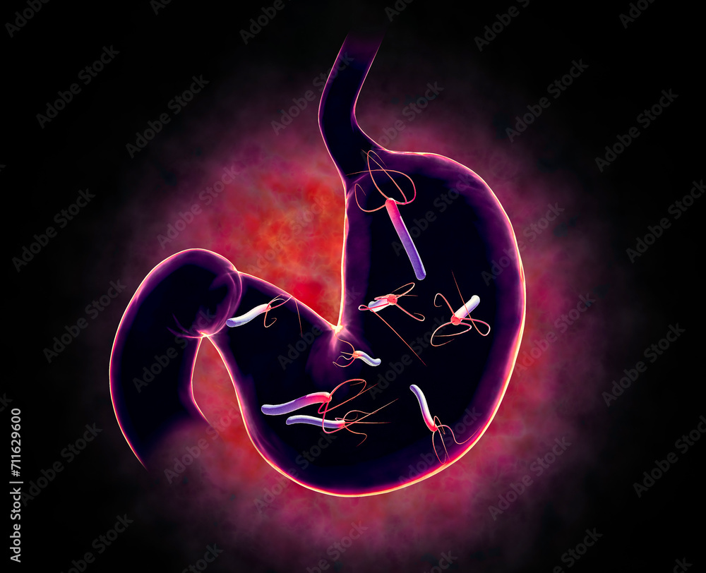 Helicobacter pylori is a gram-negative, flagellated, helical bacterium ...