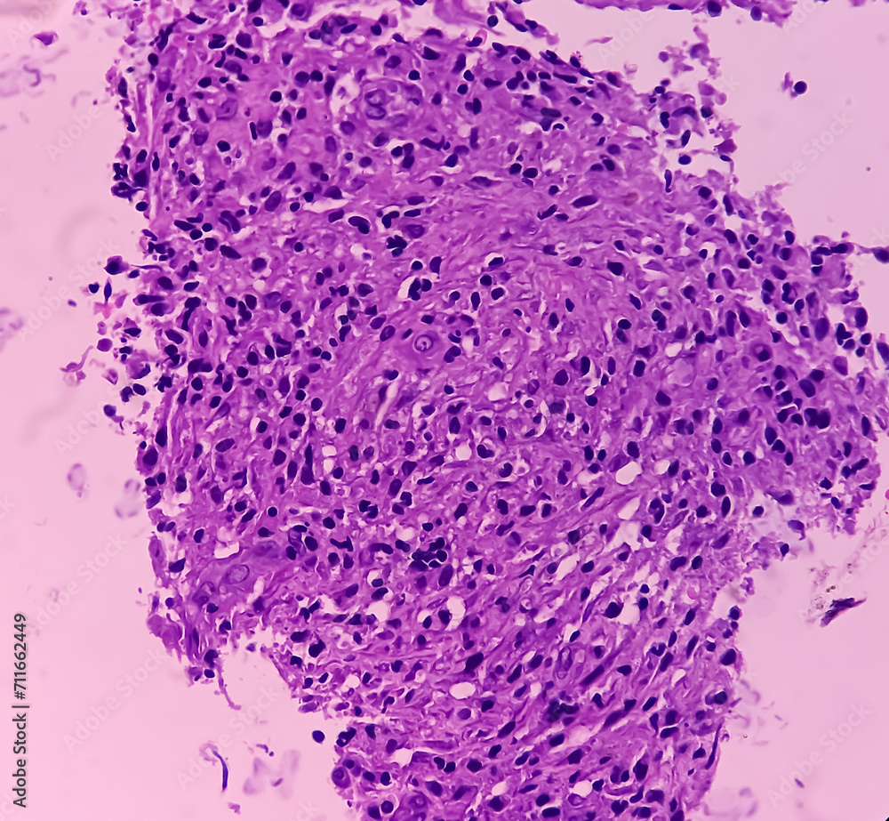 Thyroid cancer: Microscopic image of Follicular neoplasm. Malignant ...