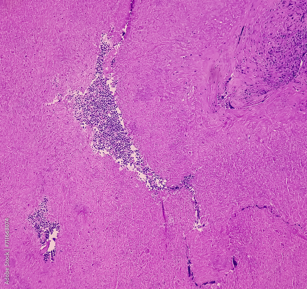 Thyroid cancer: Microscopic image of Follicular neoplasm. Malignant ...