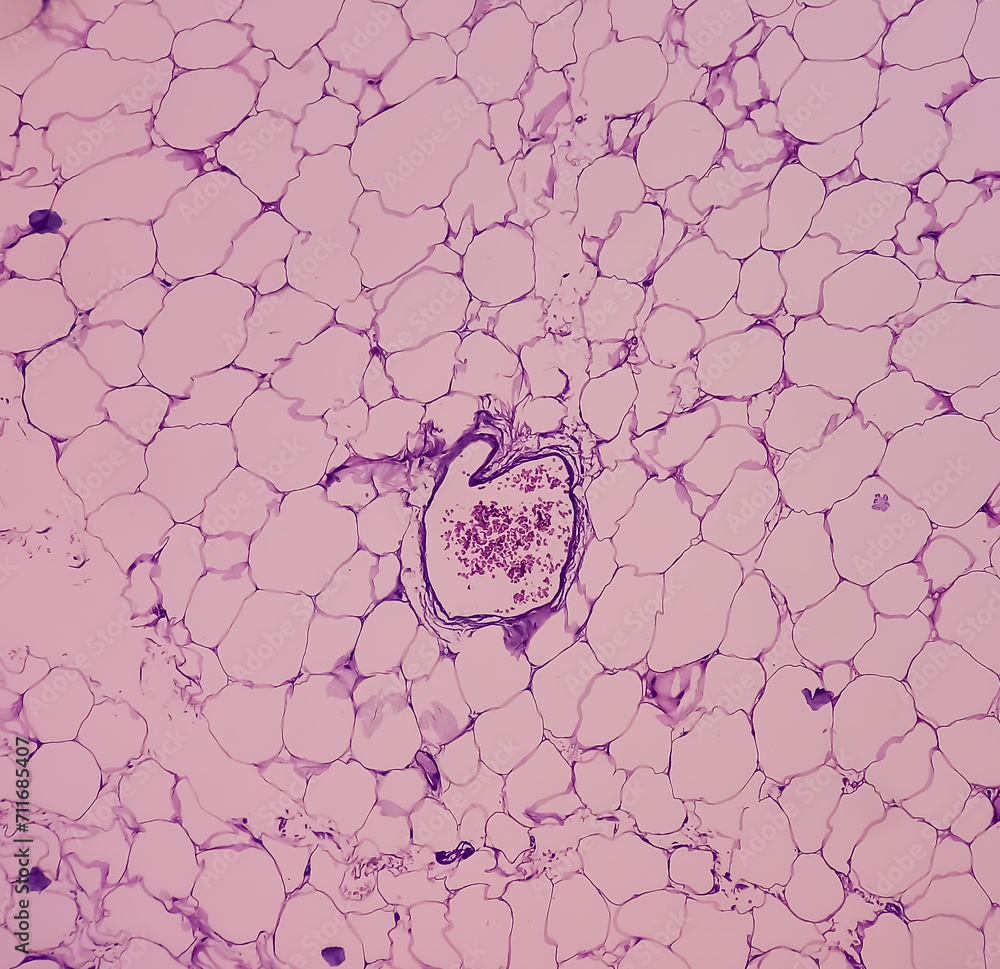 Lipoma on loin, benign growth of fatty tissue, benign neoplasm ...