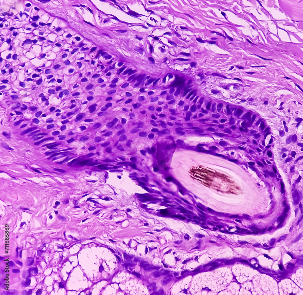 Lipoma on loin, benign growth of fatty tissue, benign neoplasm ...