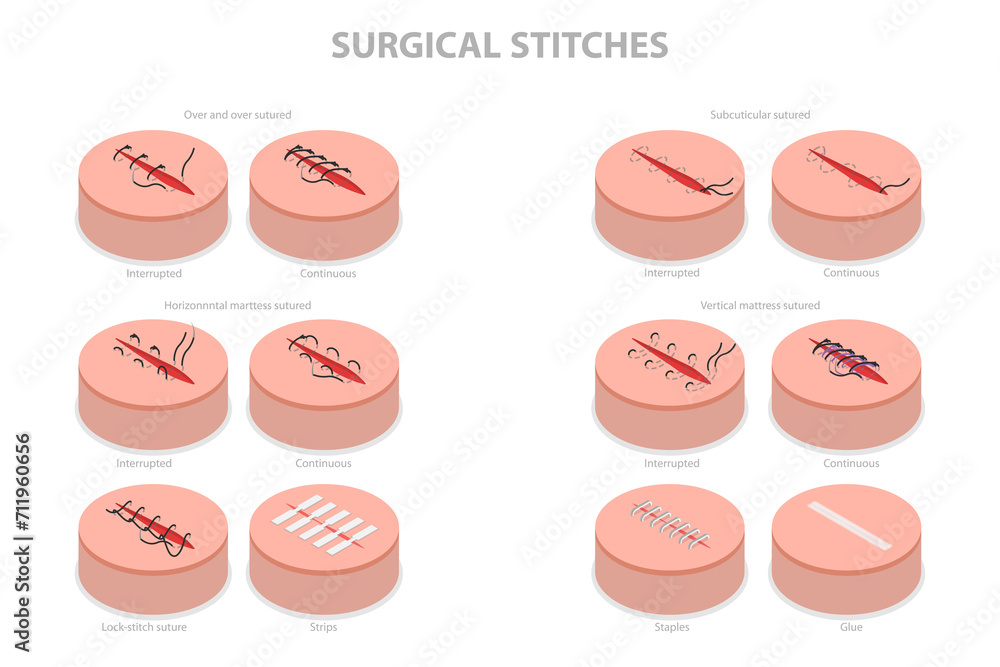 3D Isometric Flat Conceptual Illustration of Surgical Stitches, Medical ...