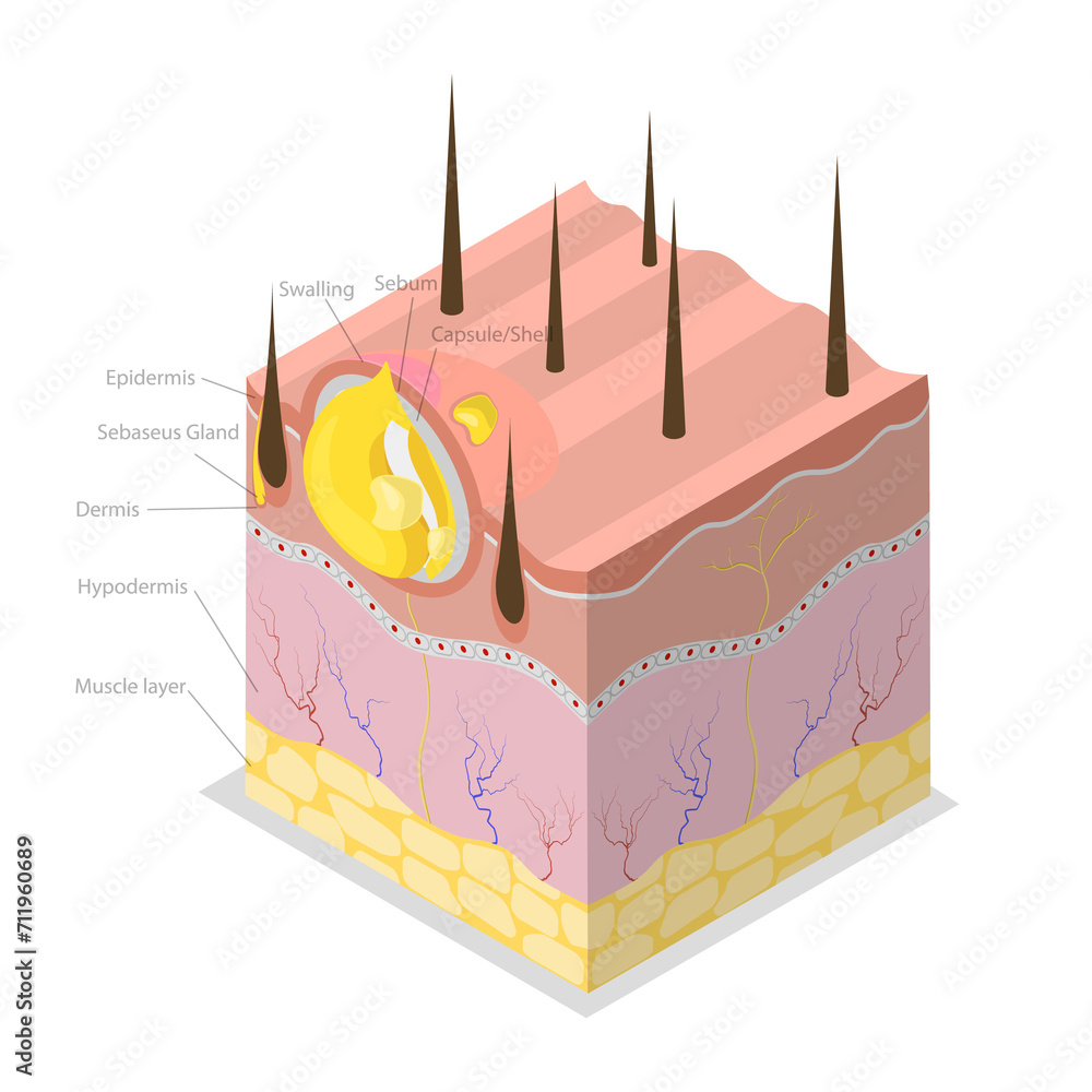 3D Isometric Flat Conceptual Illustration of Sebaceous Cyst, Medical Diagram Stock Illustration ...