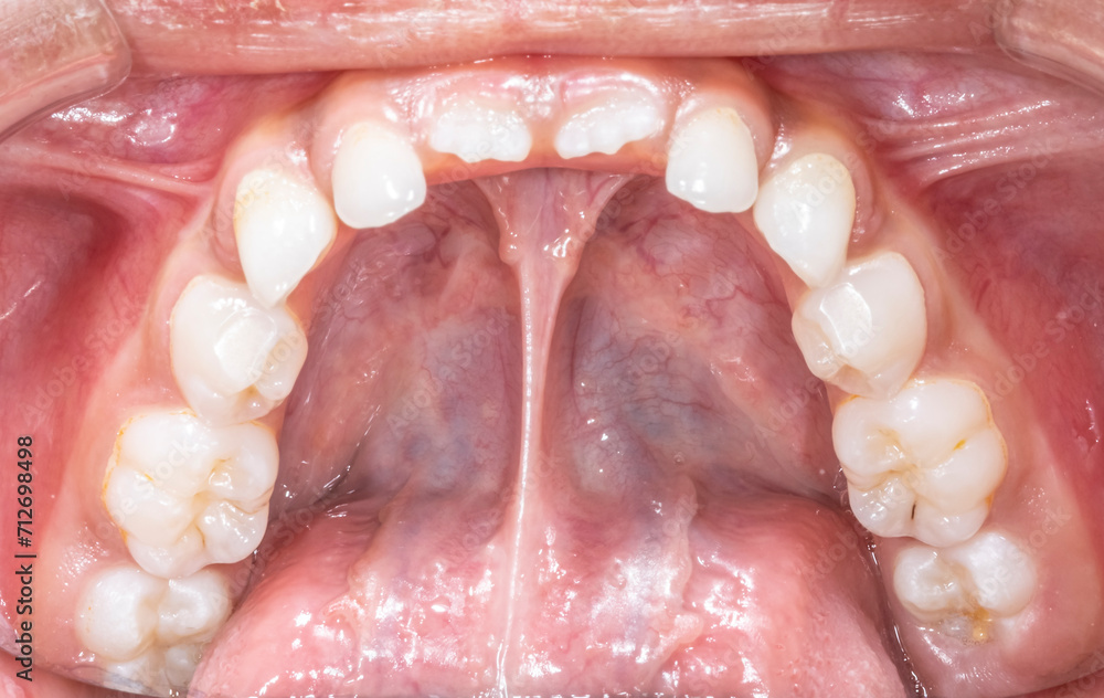 Lower mandibular arch occlusal indirect mirror view of a child milky ...