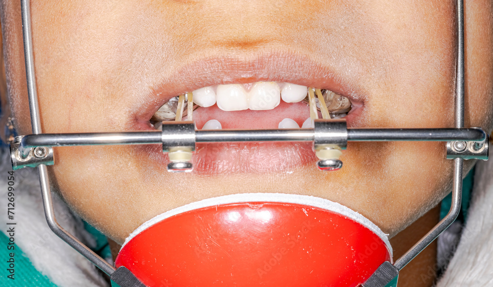 Delaire face mask for orthodontic treatment in pediatric early mixed ...