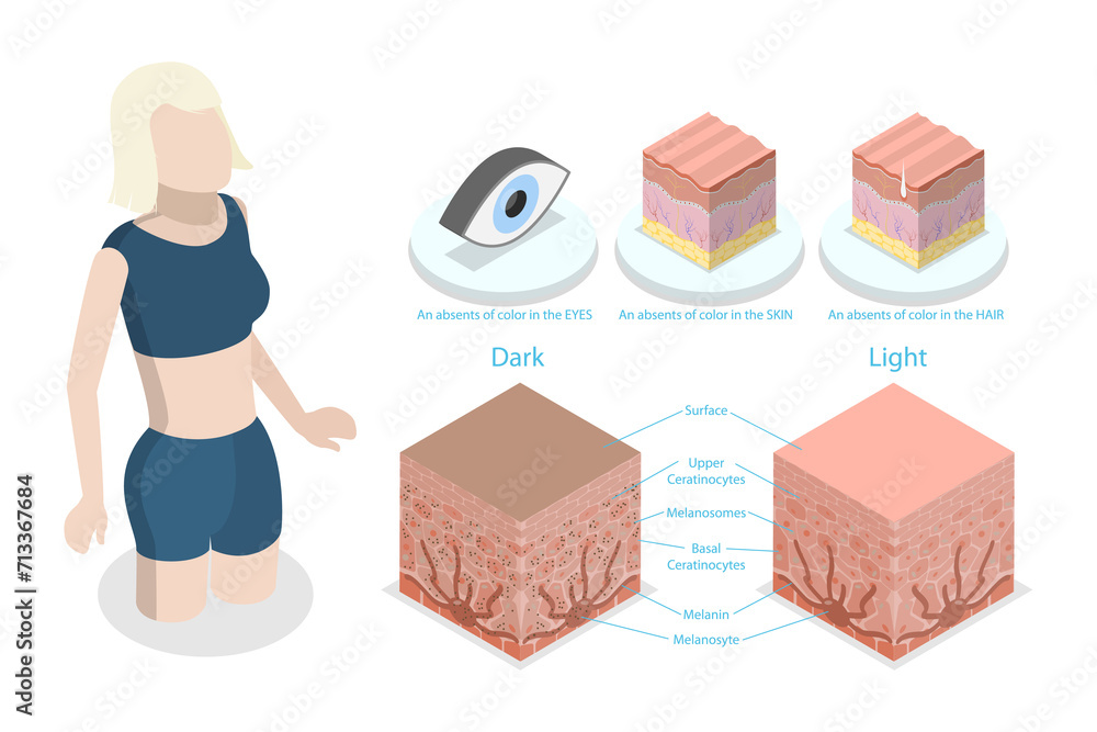 3D Isometric Flat Conceptual Illustration of Albinism, Compared Normal ...