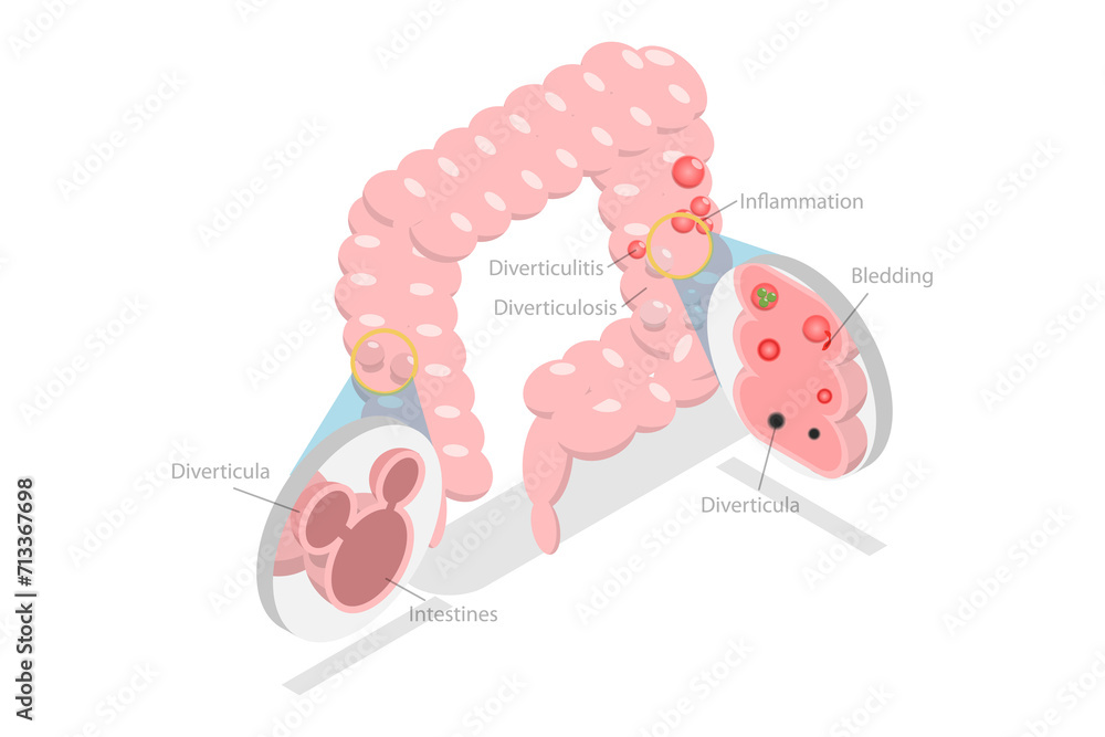 3d Isometric Flat Conceptual Illustration Of Diverticulosis And