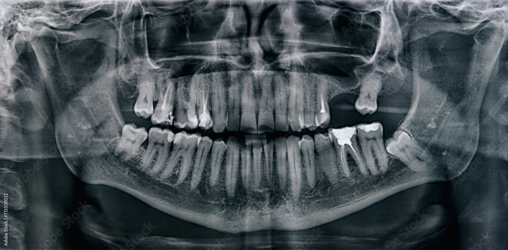 X-ray of the oral cavity with teeth. Orthopantomogram. Panoramic dental ...