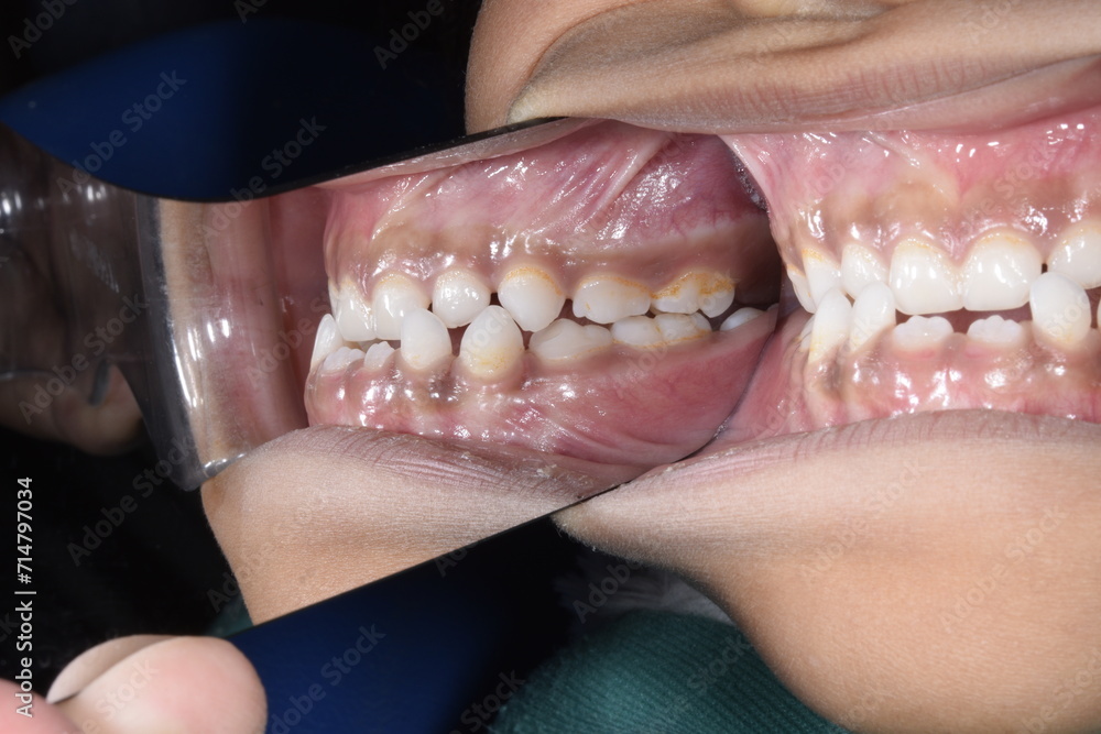 Dentistry clinical case of a biting child with class III orthodontic ...