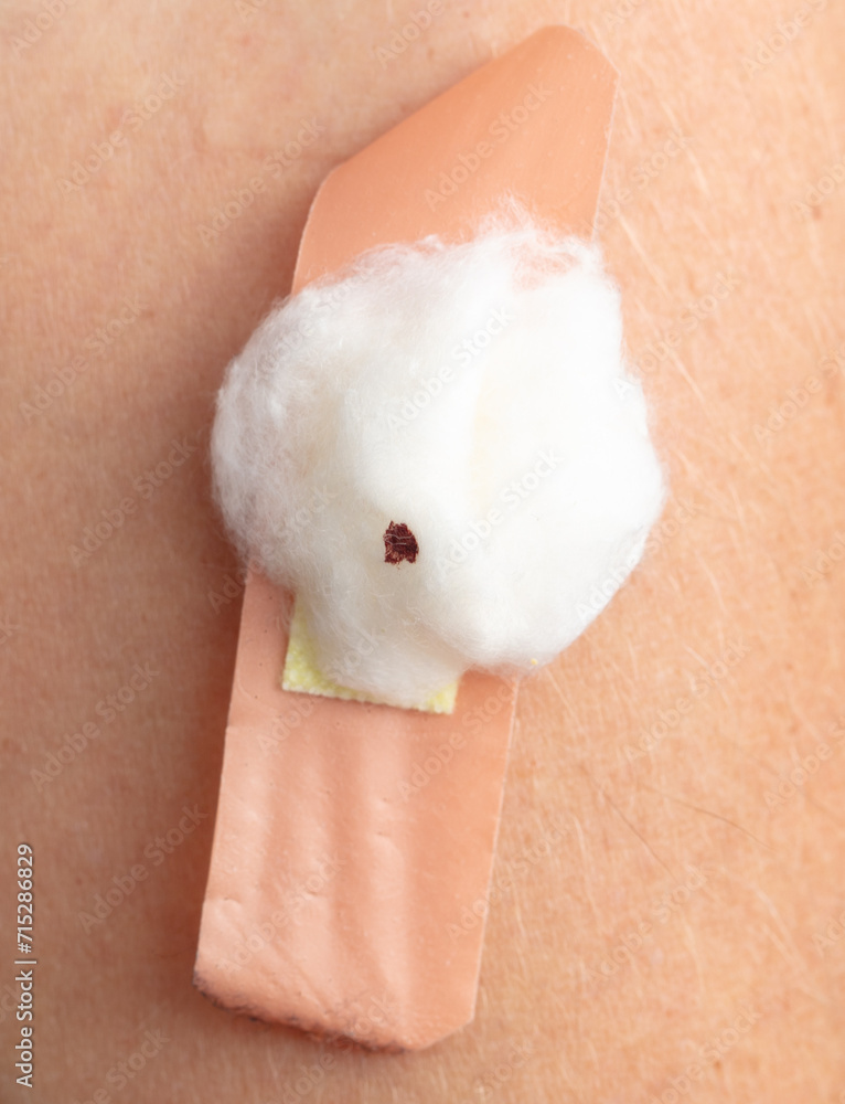 Adhesive plaster with cotton wool after an injection on the arm Stock ...