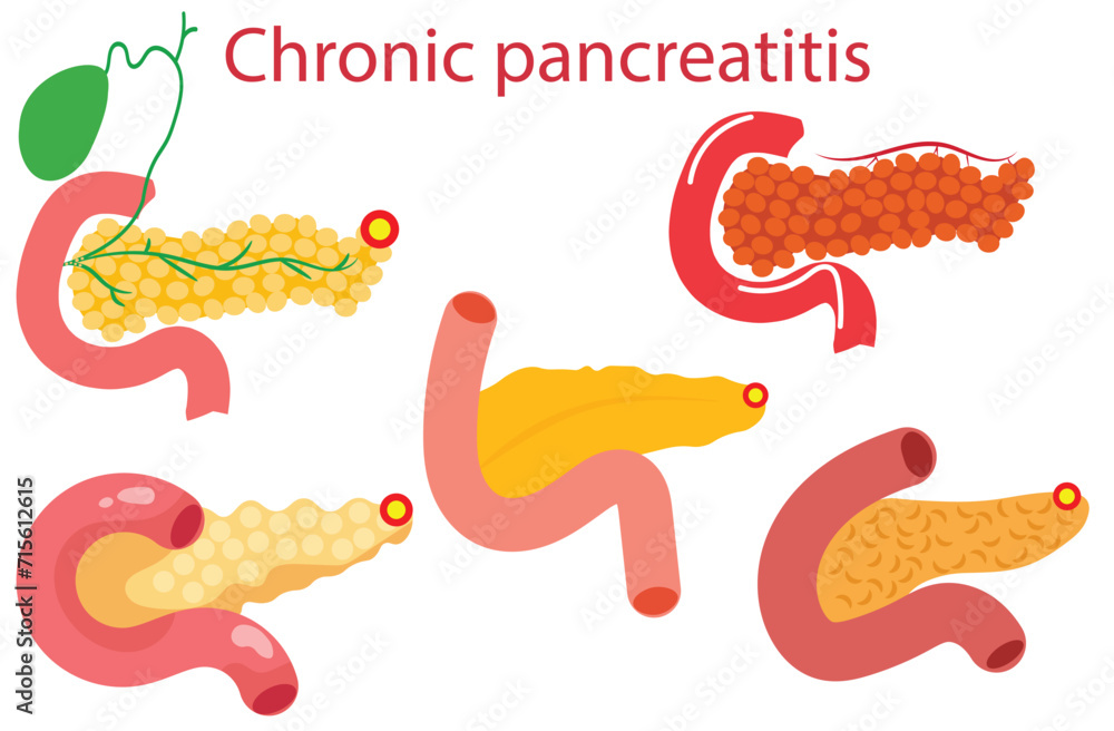 chronic pancreatitis,Pancreas disease logo, chronic pancreatitis ...