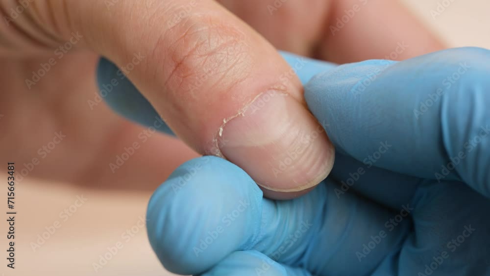 Doctor examining a ridged fingernails with vertical and horizontal ...