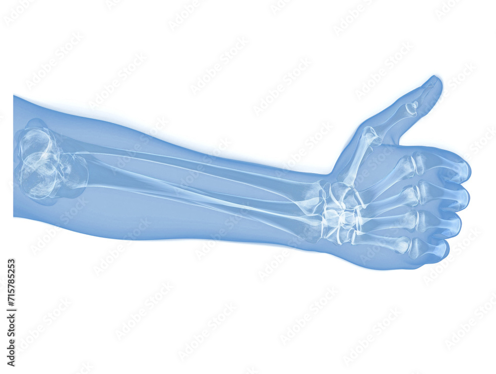 Pale light blue x-ray image of a forearm and hand with thumb up and ...