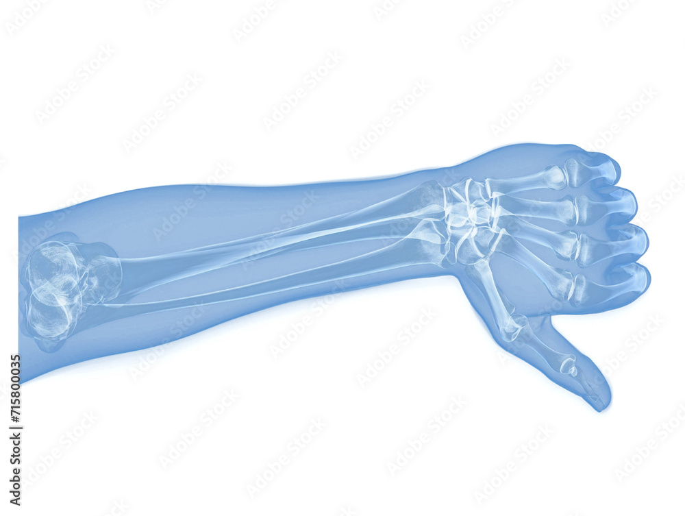 Pale light blue x-ray image of a forearm and hand with thumb down and ...