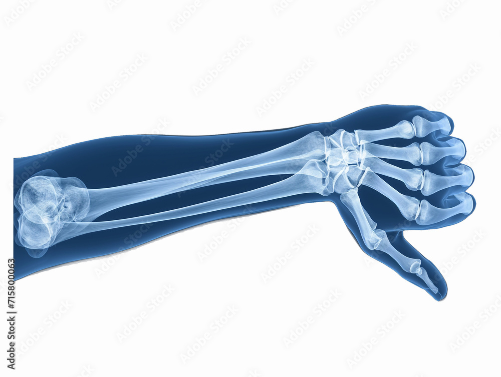 Failure symbol, x-ray image of a forearm and hand with thumb down and ...