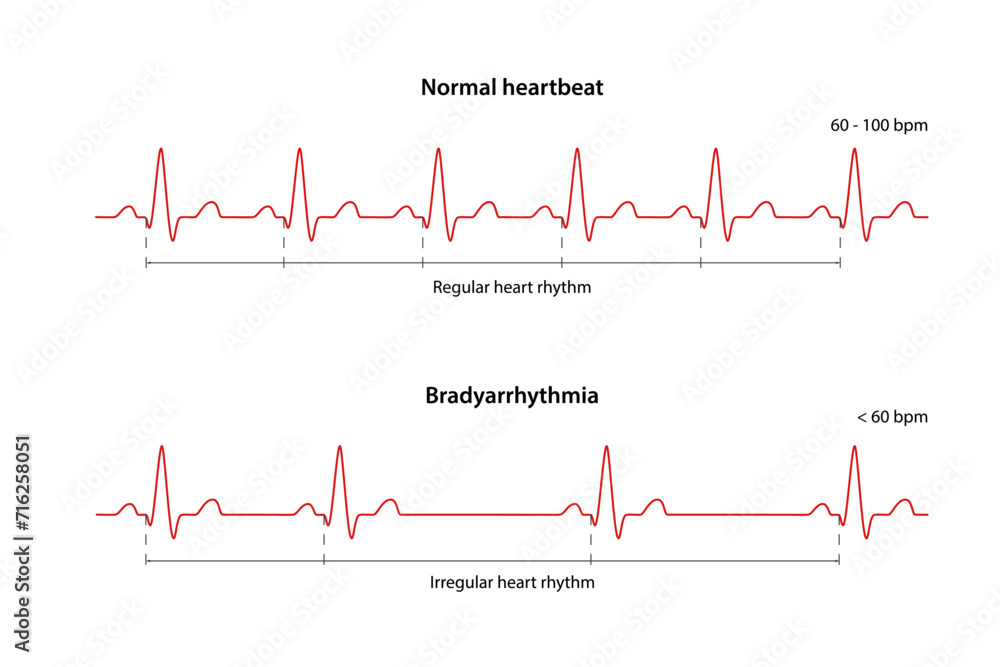 Diagram of normal rhythm and Bradyarrhythmia for a human heart. Heart ...