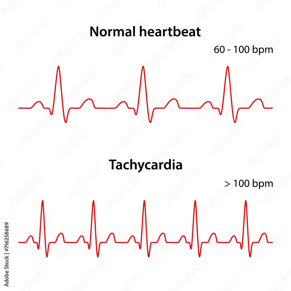 Diagram of normal rhythm and Tachycardia for a human heart. Heart ...